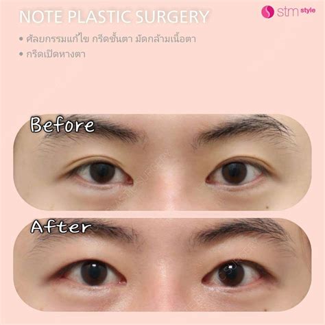Eyelid Surgery To Create A Crease And Tighten The Eye Muscles Stm Style