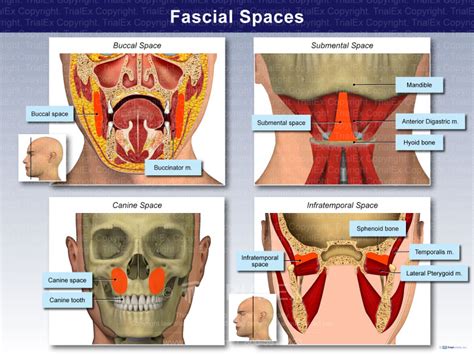 Infratemporal Space A Exposure Of The Infratemporal Fossa Is Achieved