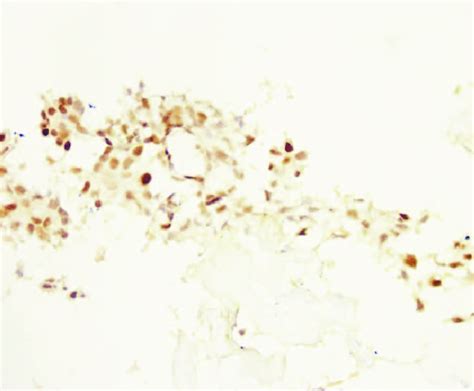 Immunohistochemical Staining Showed Diffuse Expression Of Pax8 In