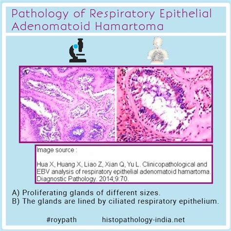 Pathology Of Respiratory Epithelial Adenomatoid Hamartoma Educational