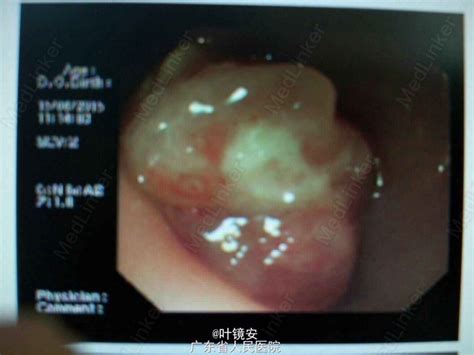 食管下段 贲门 胃底癌一例 医联