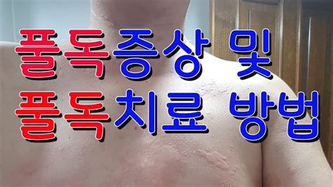 풀독증상 및 풀독치료 방법 Youtube