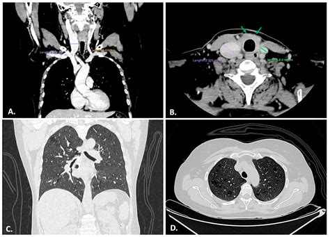 Igg4 Mediated Sclerosing Riedel Thyroiditis A Multidisciplinary Case