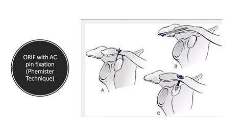 Ac Joint Dislocation Pptx