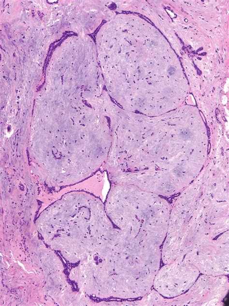 Myxoid Fibroadenoma Mgh Learn Pathology
