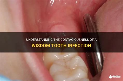 Understanding The Contagiousness Of A Wisdom Tooth Infection Medshun