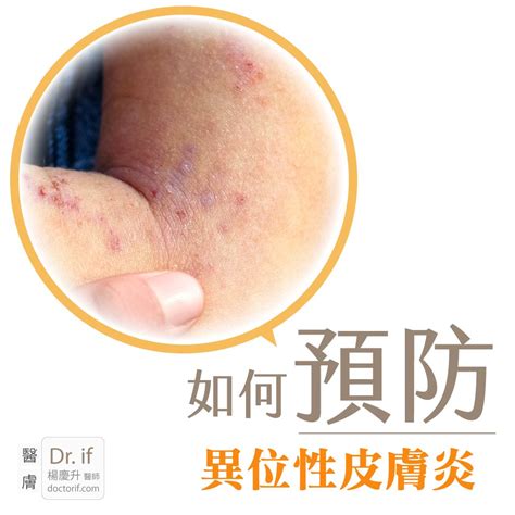 醫膚親子皮膚專科診所 短暫控制異位性皮膚炎不是太困難的事情 🚩但維持良好的狀態 🚩減少復發或減低復發的嚴重程度