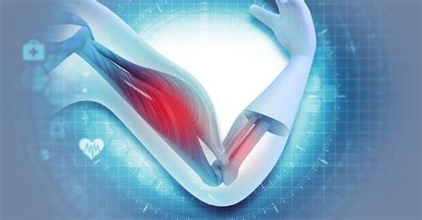 Acute Repair Of Distal Biceps Tendon Rupture May Have Advantages Vs