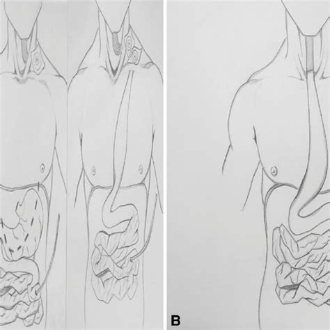 Modified Stage Esophagectomy With Anchoring Of The Gastric Conduit