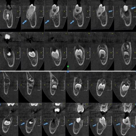 The Cross Sectional Reconstructed Views Of The Cbct Show The Bilateral