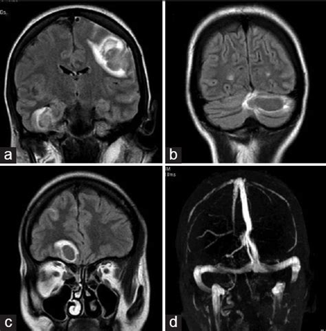 Multiple Intracranial Hemorrhages In Pregnancy A Common Autoimmune