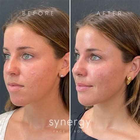 Masseter Botox Before And After Before After Journey