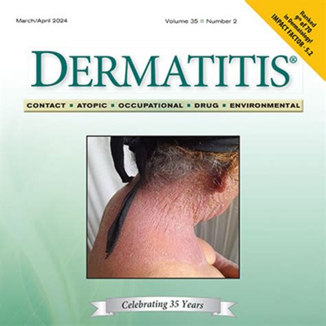 American Contact Dermatitis Society On Linkedin Acds Dermatitis