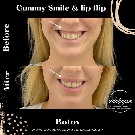These Results Are After Few Units Of Botox In Upper Lip 👄 To Make The