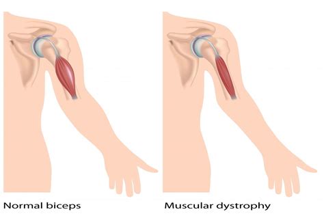 Muscular Dystrophy Causes Symptoms And Treatment Options