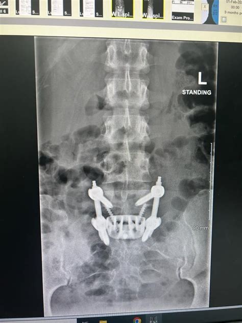 Alif Plif L4 S1 Fusion Returning To Work R Spinalfusion