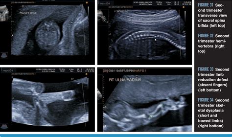 Figure 3 From Prenatal Ultrasound Microbiome In Prematurity Bleeding