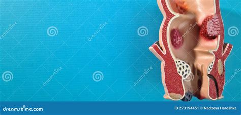 Anatomy Of The Anus And Treatment Of Diseases Of Rectum Hemorrhoids