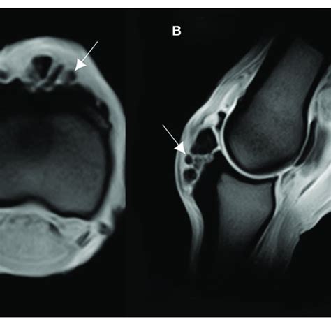 A T1 Weighted Gradient Echo Gre Transverse Magnetic Resonance Download Scientific Diagram