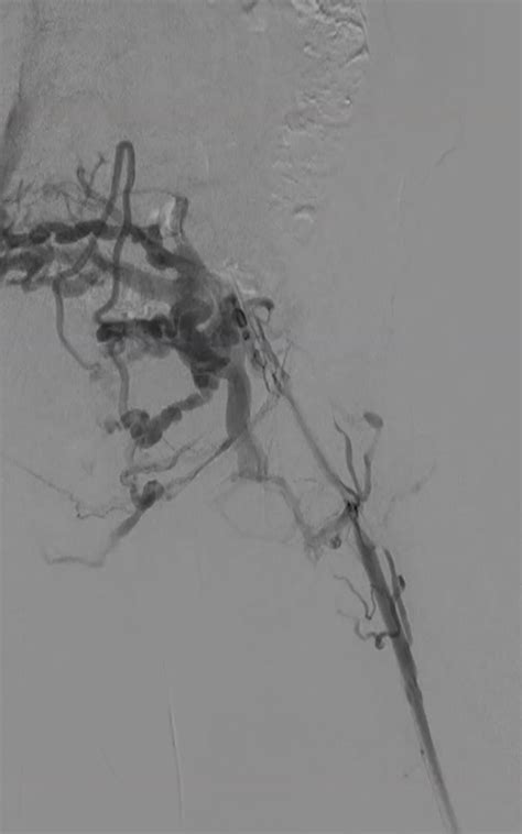 Video State Of The Art Endovascular Management Of Venous Diseases