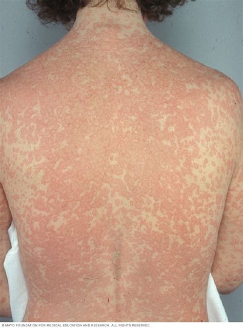 Amoxicillin Rash