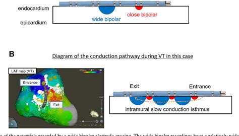 A Case Of Ventricular Tachycardia With An Intramural Excitable Substrate Detected By Evaluating