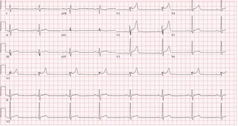 Ekg On Day 1 Showing Bradycardia Download Scientific Diagram