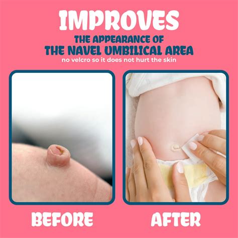 Newborn Umbilical Hernia