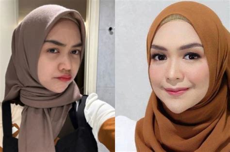 Ria Ricis Operasi Plastik Di Hidung Takut Tak Bangun Karena Bius Total