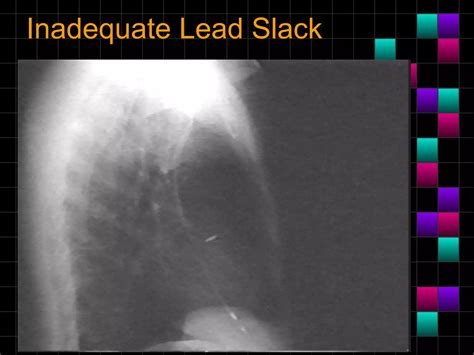 Pacemaker Radiologyanintroduction Ppt