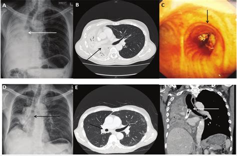 Malignant Central Airway Obstruction Radiology Key