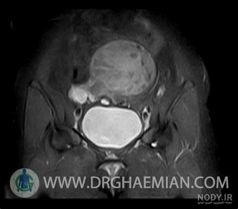 عکس ام ار ای از رحم عکس نودی