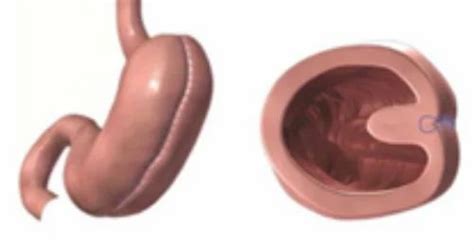 Gastric Imbrication Surgery Medical Surgery Services Livlife