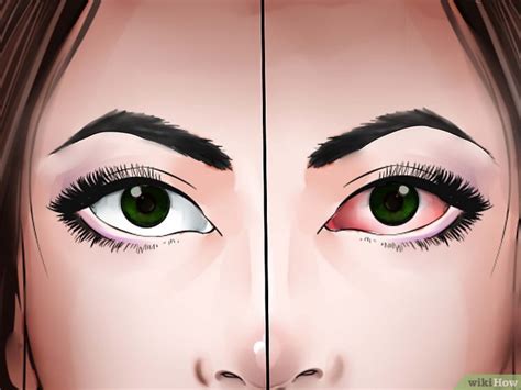 How To Treat Eye Infections Naturally