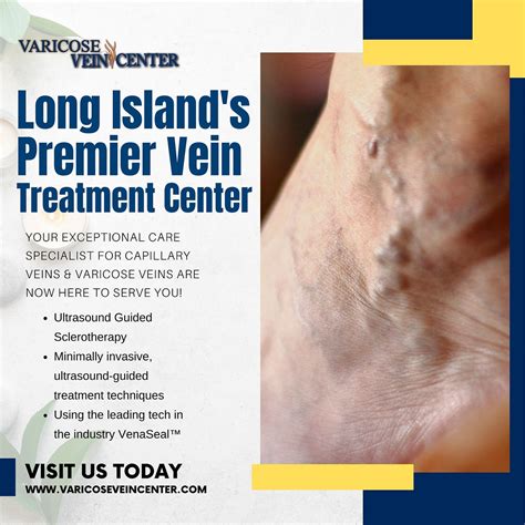 Vein Doctor — Port Jefferson Ny Vein Doctor Nyc — What Can A Vein