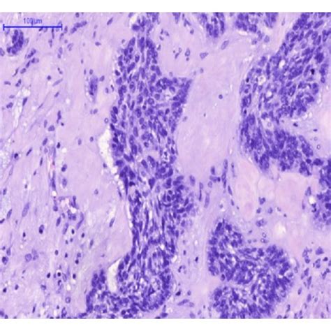 Year Old Man With Cholangiocarcinoma Bismuth Type Iv And Right Portal