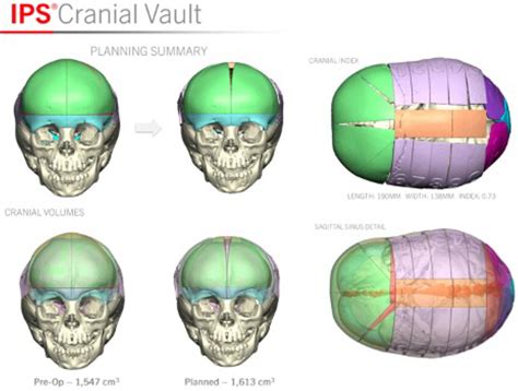 Virtual Surgical Planning Summary Renderings Compiled From The