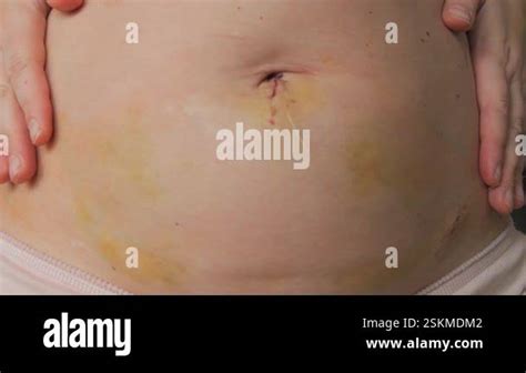 Close Up Of A Womans Abdomen Showing A Healing Surgical Scar After A
