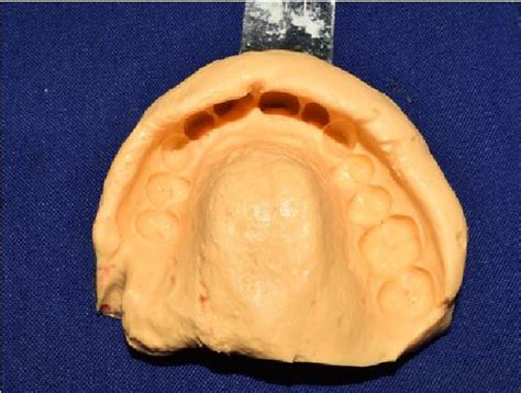 Primary Impression Of The Maxillary Arch Download Scientific Diagram