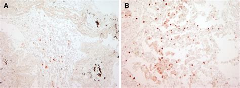 Expression Of Ki 67 In Human Non Small Cell Lung Cancer Tissue In