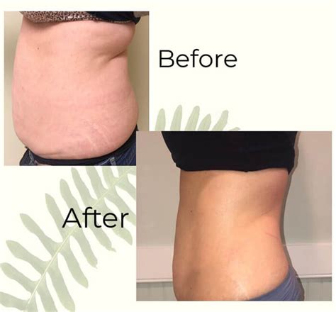 Before And After Transformations Bellaesteticact