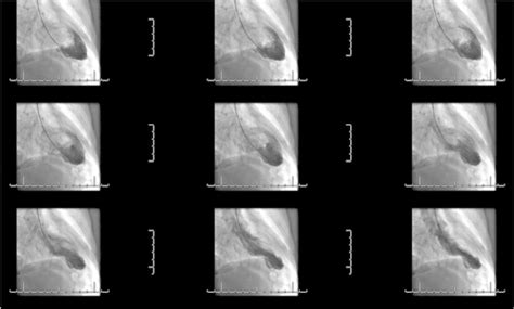 Ventriculography Showing Hypokinesia In The Inferoapical Wall Of The Heart Download