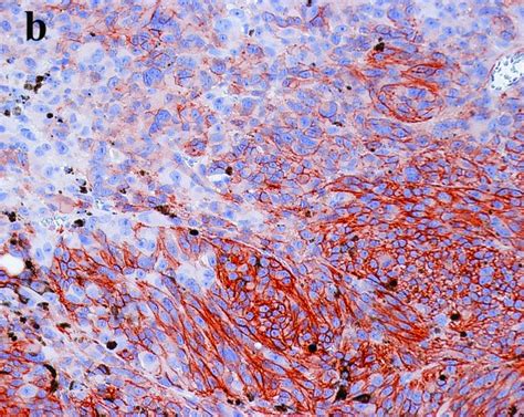 The Role Of C Kit And Imatinib Mesylate In Uveal Melanoma Carcinogenesis