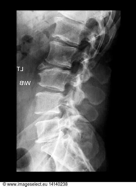 Limbus Vertebrae On X Ray Limbus Vertebrae On X Ray Abnormal X Ray