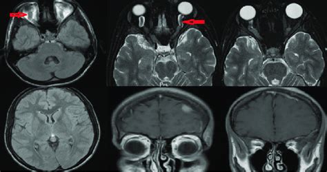 Computerized Visual Field Exam Showed Bilateral Concentric Download Scientific Diagram