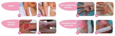 Urgo Medical Urgotul Range Details