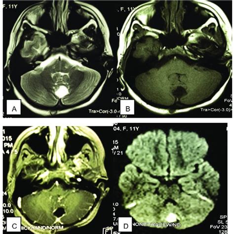 A Axial T2 Weighted Brain Mri And B Axial T1weighted Brain Mri Shows