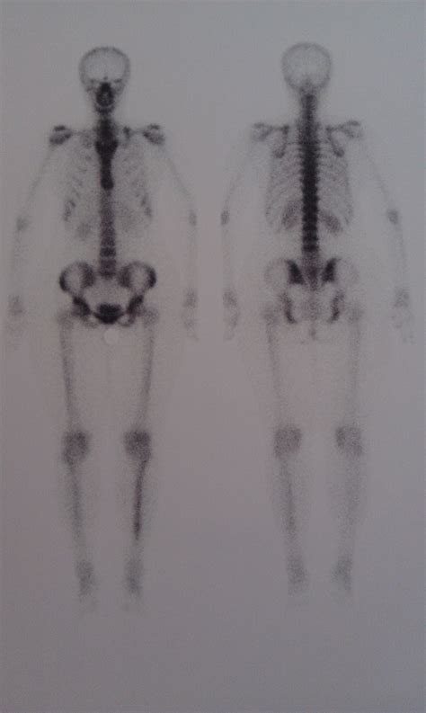 Diagnosis Of Shin Splint A Case Report Published In Surgicoll