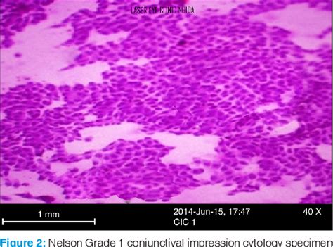 Figure From The Diagnostic Value And Accuracy Of Conjunctival Impression Cytology Dry Eye