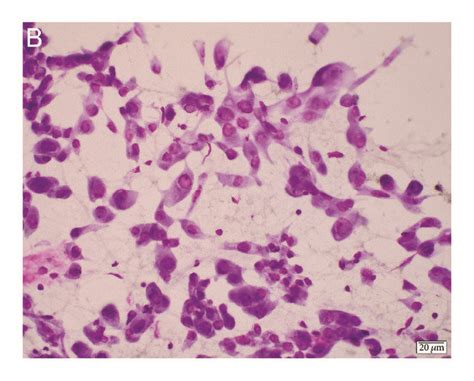 Metastatic Papillary Thyroid Cancer In A Lymph Node A Ultrasound